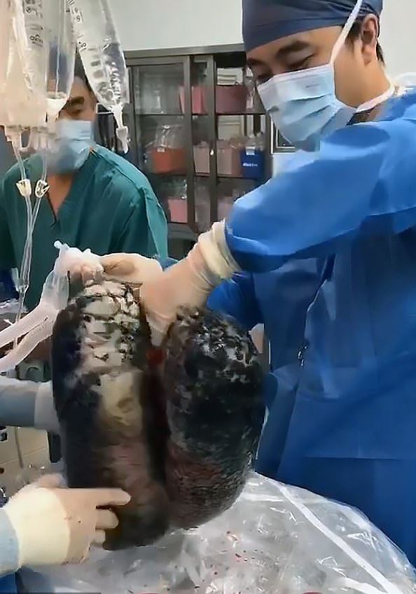 Medicii au dezvăluit cum arată plămânii unui bărbat care a fumat timp ...