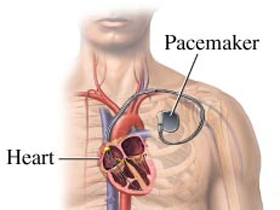 Pacemakerele şi defibrilatoarele cardiace, vulnerabile la pirateria ...